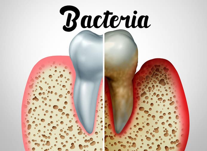 Bone Loss in Teeth: Causes, Treatment & Prevention | News Ronic Bone Loss in Teeth: Causes, Treatment & Prevention | News Ronic